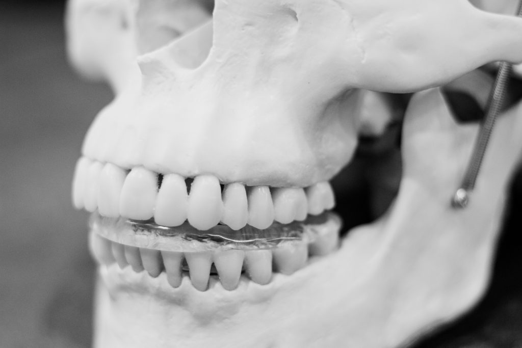 Splint Therapy for Popping Jaw - TMJ Treatment Atlanta Splint Therapy for Popping Jaw - TMJ Treatment Atlanta